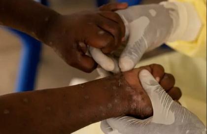 Mpox: conheça sintomas e tire principais dúvidas sobre a doença ...